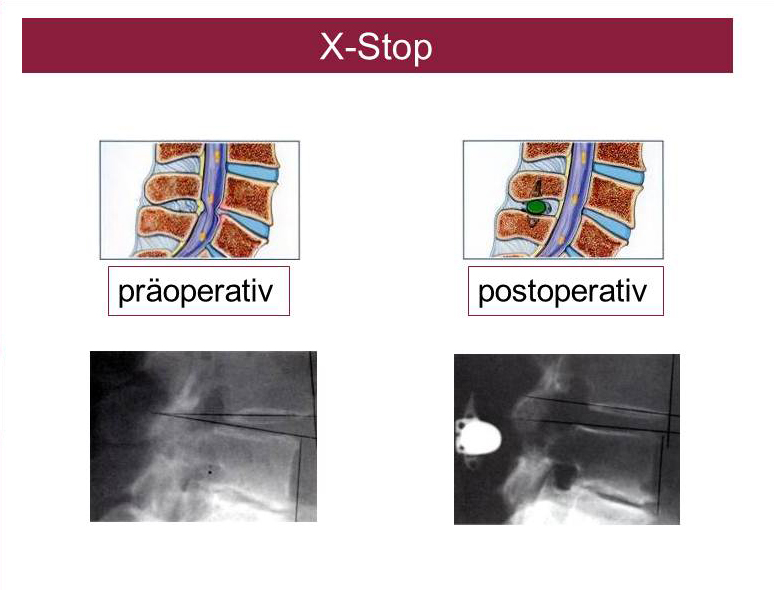X-Stop - Dr. Heidt und KollegenDr. Heidt und Kollegen